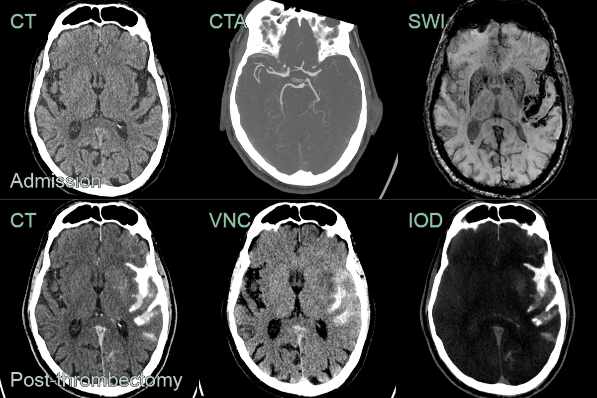 Acute Ischemic Stroke - Neuroradiology