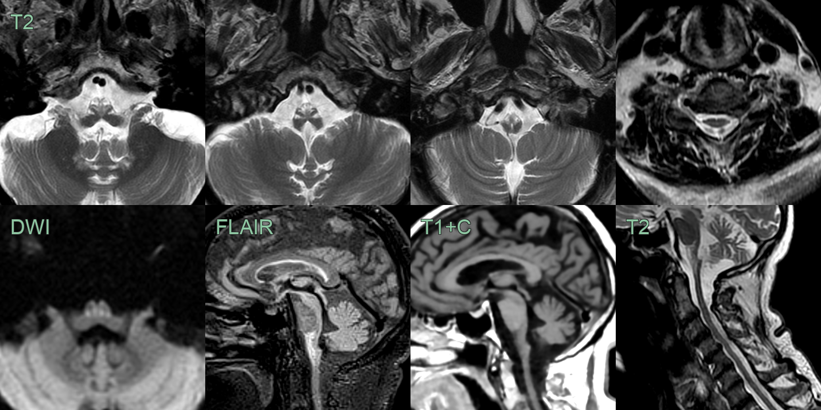 Adult Onset Alexander's Disease - Neuroradiology