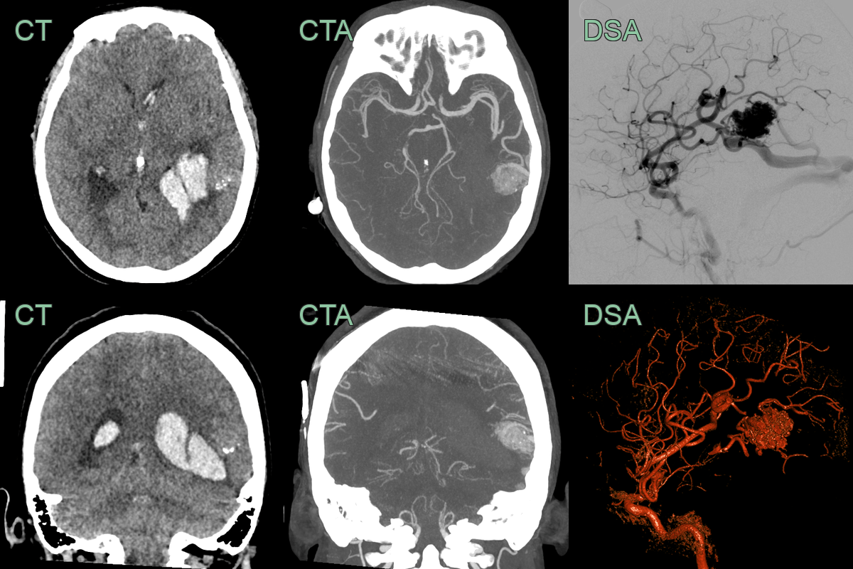Arteriovenous malformation - Neuroradiology