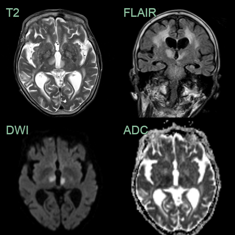 Artery of Percheron infarct - Neuroradiology