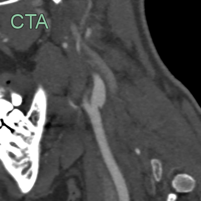 Carotid web - Neuroradiology