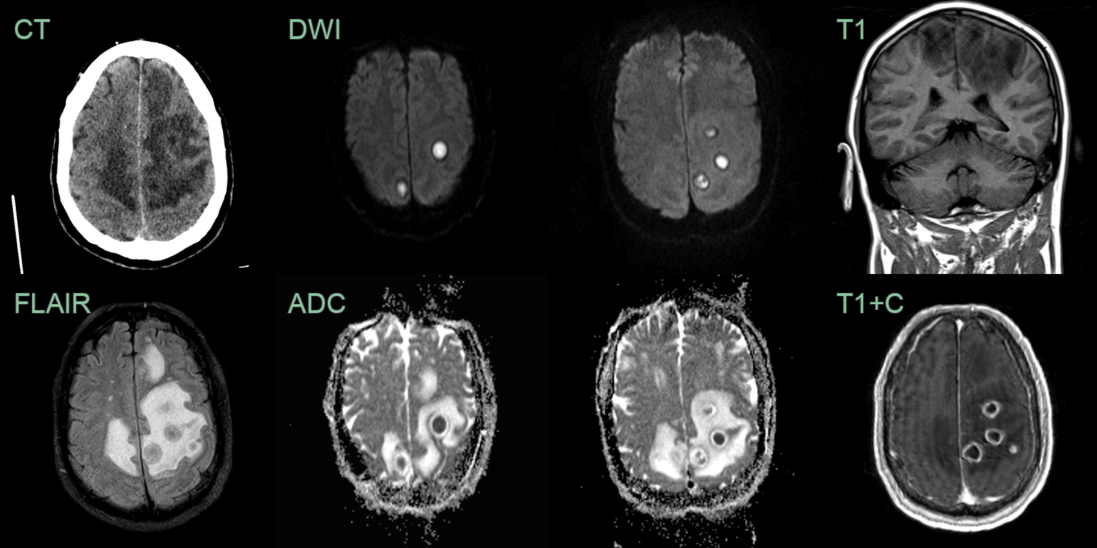 Cerebral abscess - Neuroradiology