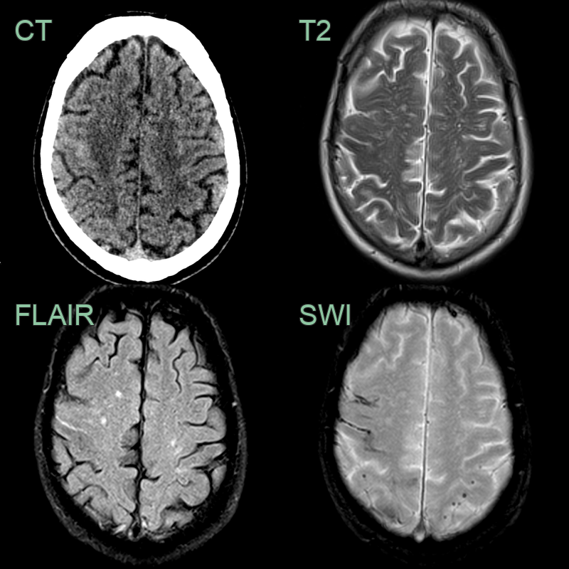 Cerebral Amyloid Angiopathy (CAA) - Neuroradiology