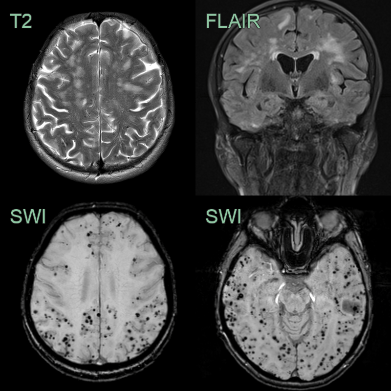 Cerebral Amyloid Angiopathy (CAA) - Neuroradiology