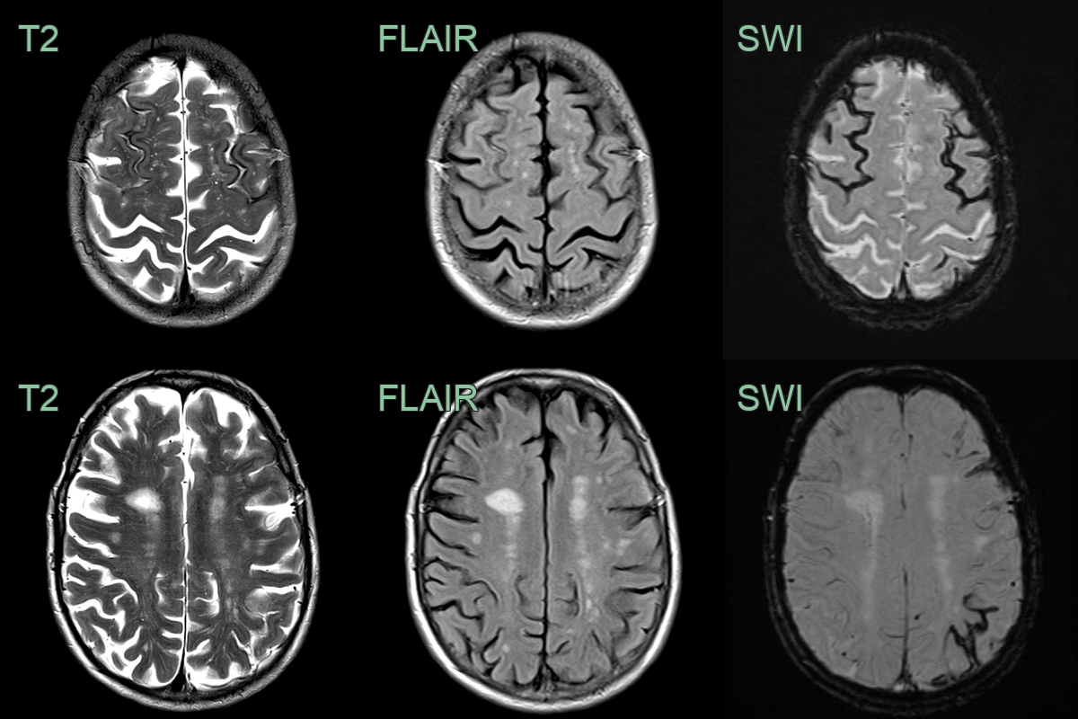 Cerebral Amyloid Angiopathy (CAA) - Neuroradiology