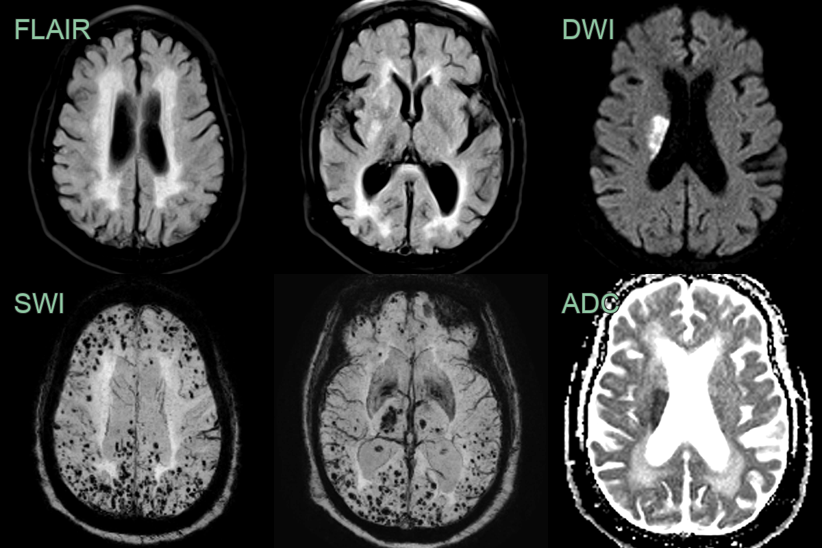 Cerebral Amyloid Angiopathy (CAA) - Neuroradiology