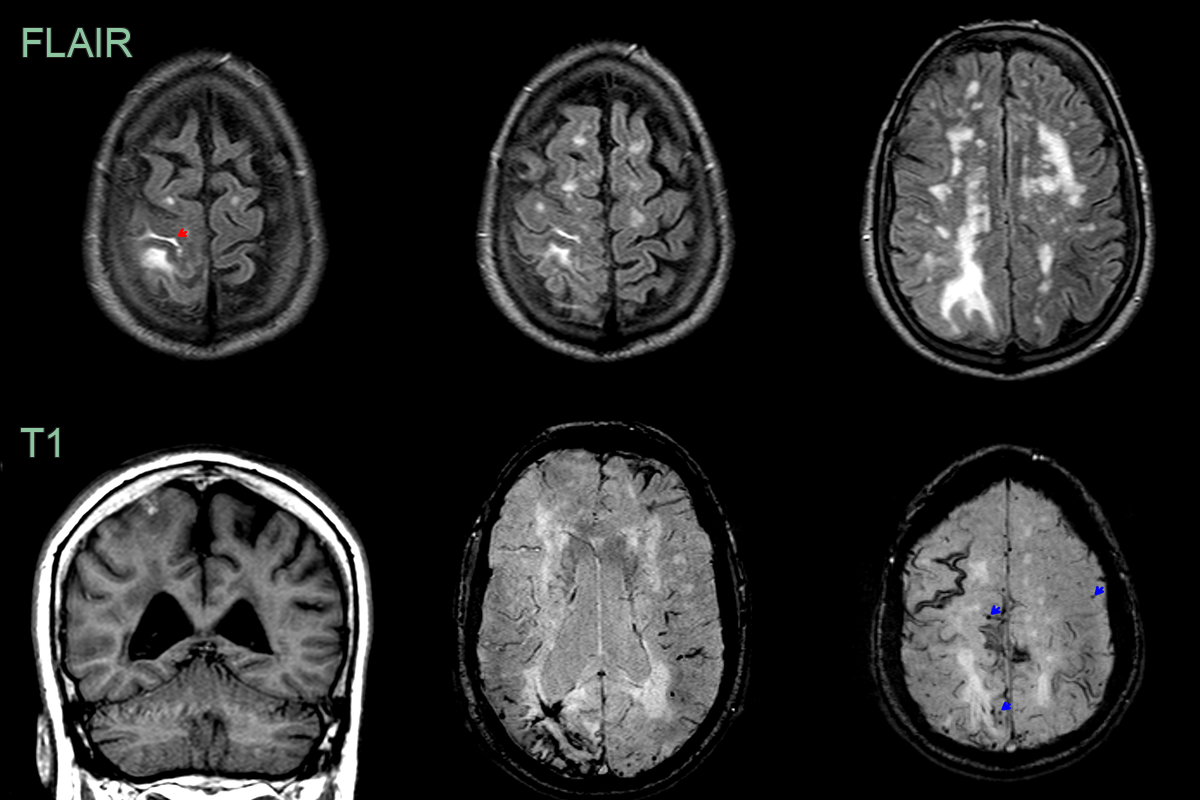 Cerebral Amyloid Angiopathy (CAA) - Neuroradiology