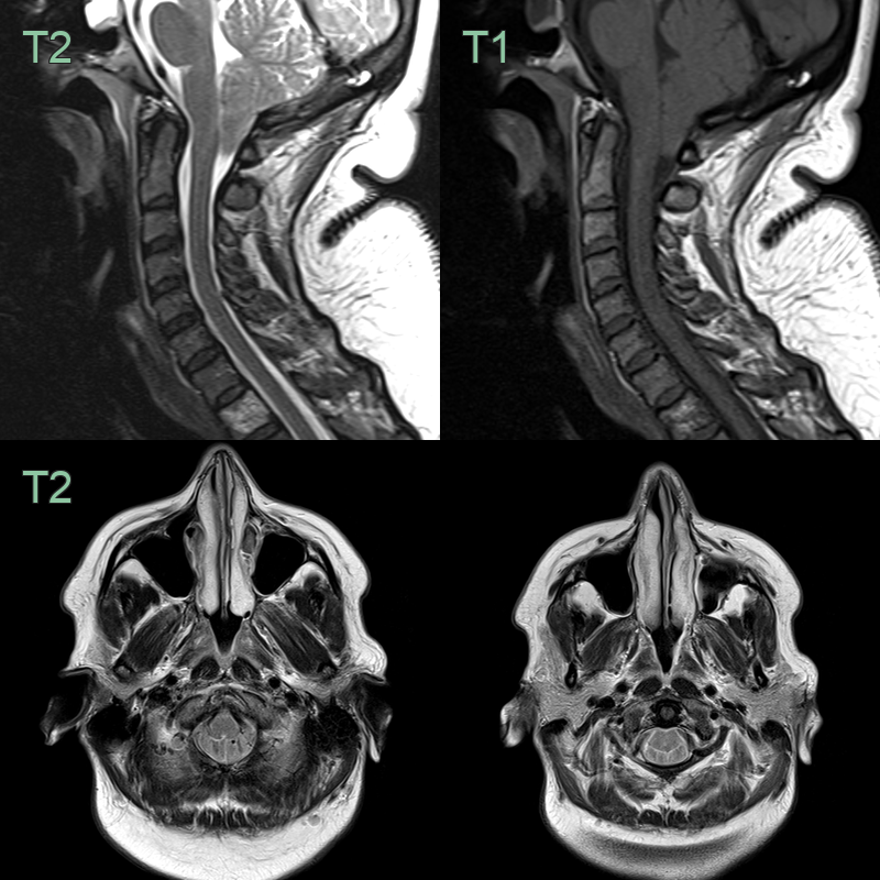 Chiari I malformation - Neuroradiology
