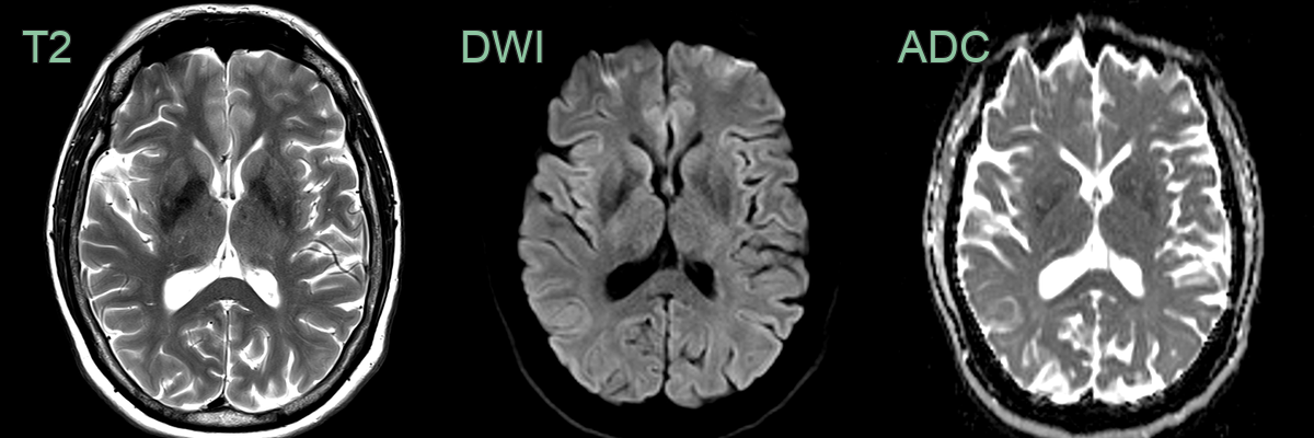 Creutzfeldt-Jakob disease (CJD) - Neuroradiology