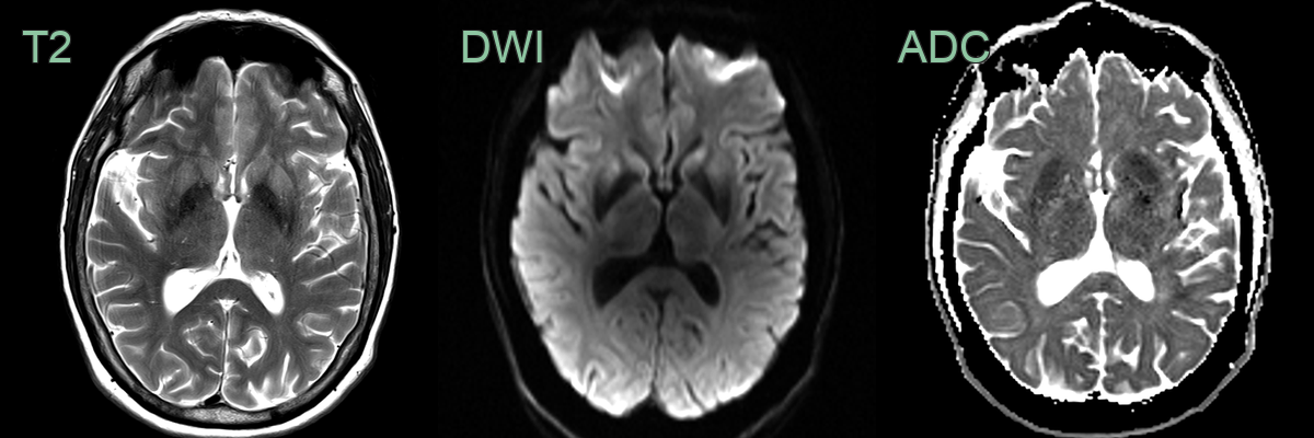 Creutzfeldt-Jakob disease (CJD) - Neuroradiology