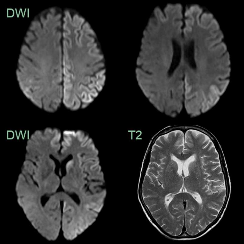 Creutzfeldt-Jakob disease (CJD) - Neuroradiology