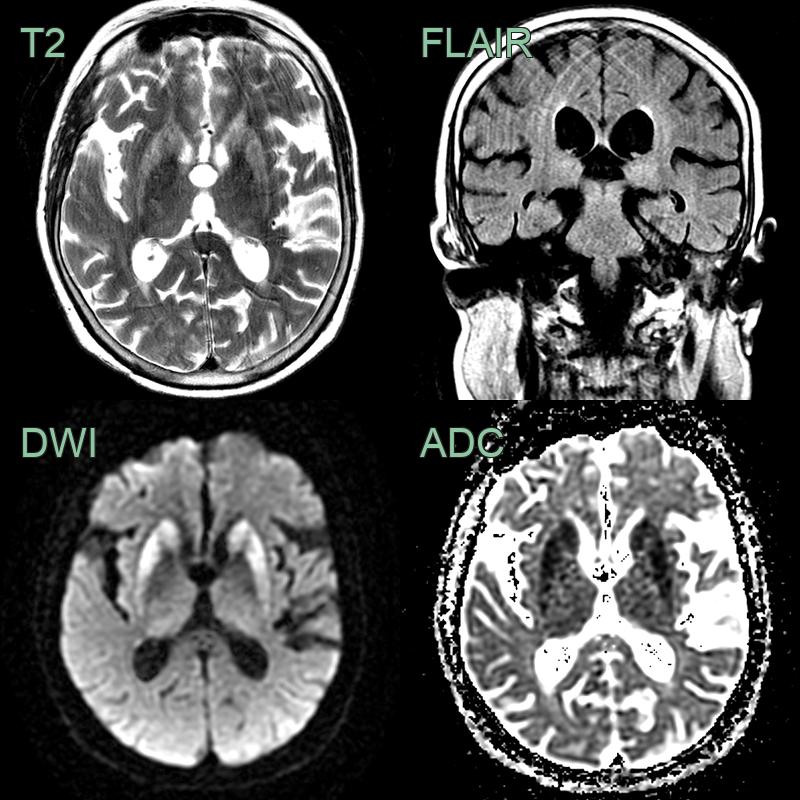 Creutzfeldt-Jakob disease (CJD) - Neuroradiology