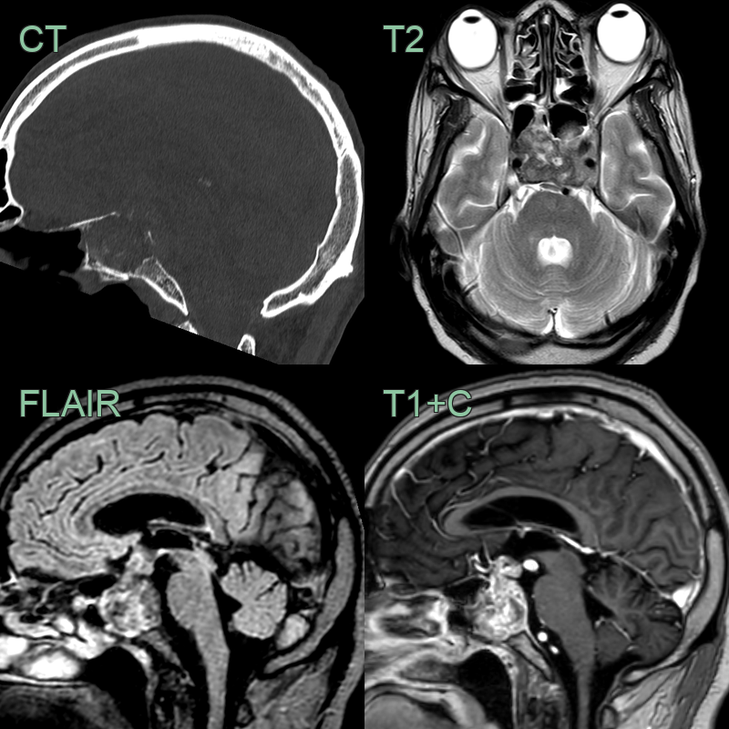 Clival metastasis - Neuroradiology