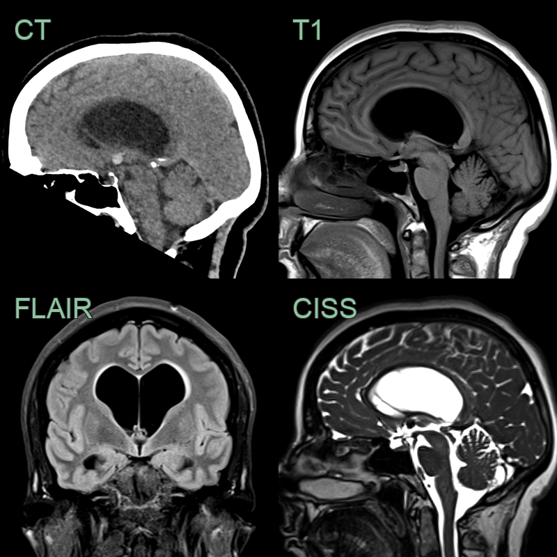 Colloid cyst - Neuroradiology