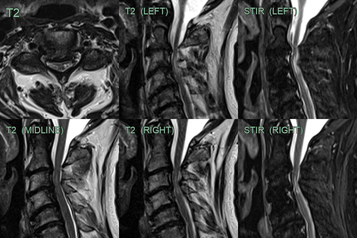 Compressive myelopathy - Neuroradiology