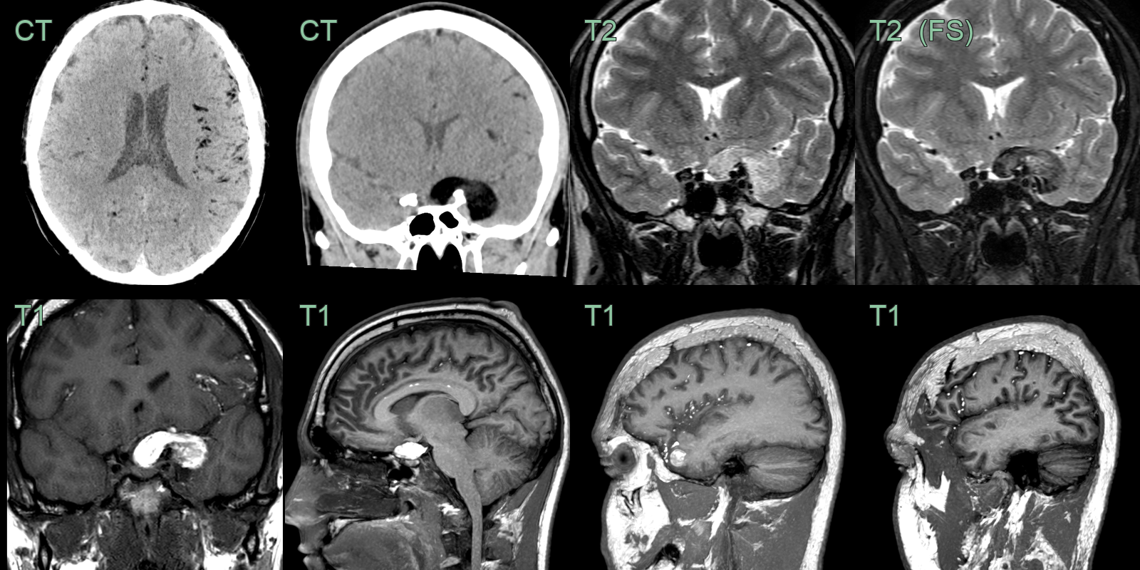 Dermoid Cyst - Neuroradiology