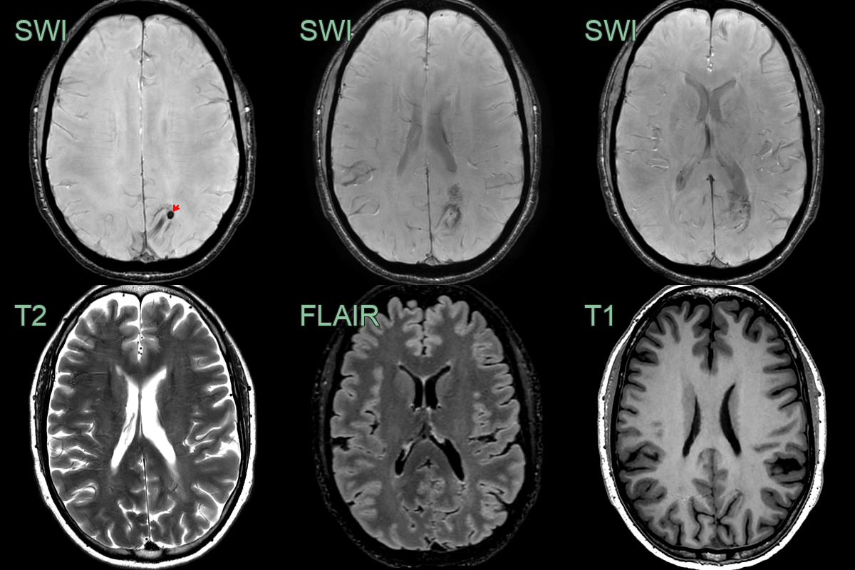 Developmental Venous Anomaly (DVA) - Neuroradiology