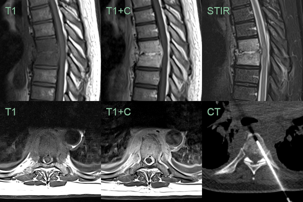 Discitis - Neuroradiology
