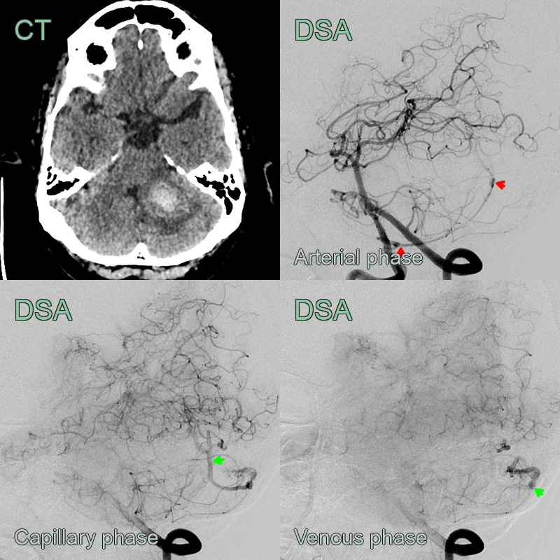 Dural arteriovenous fistula - Neuroradiology