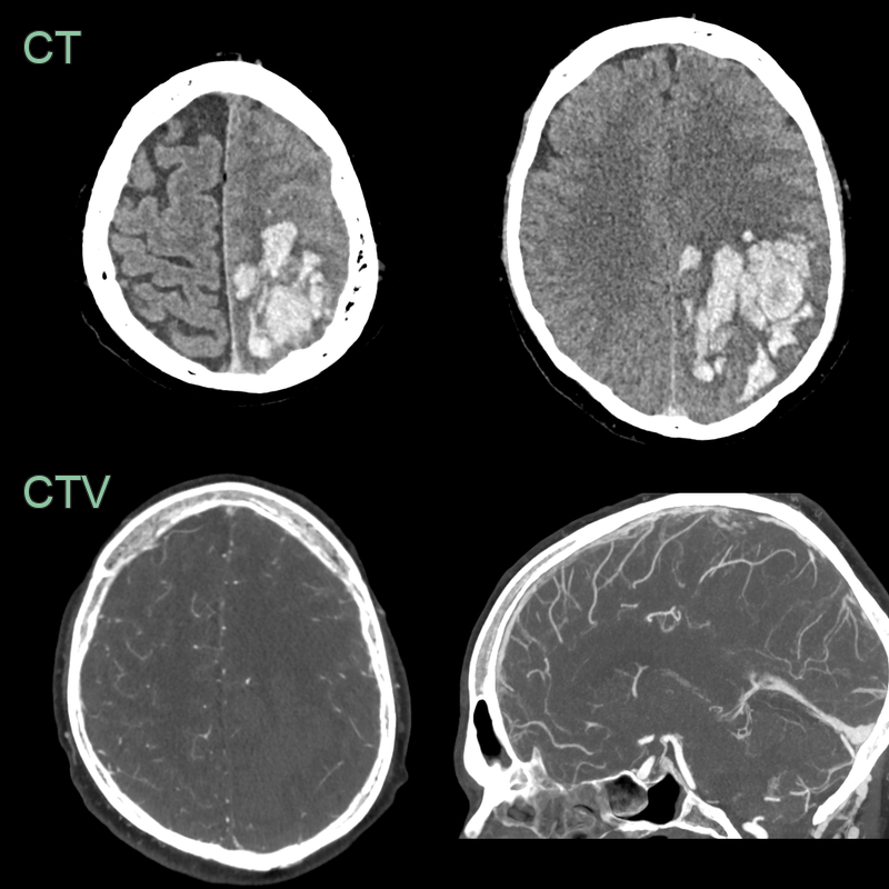 Dural venous sinus thrombosis - Neuroradiology