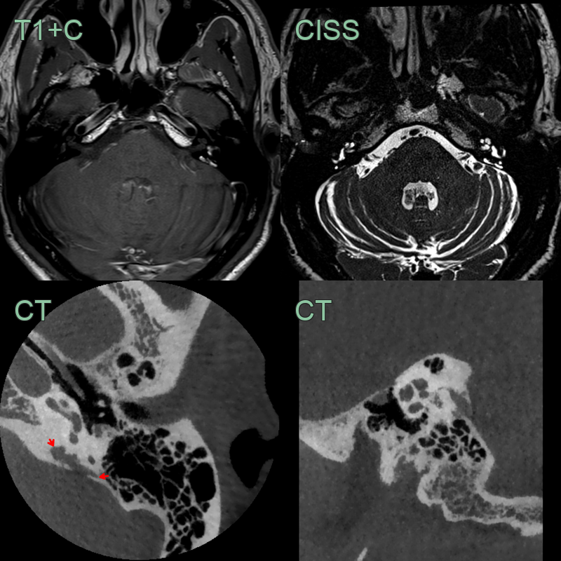 Endolymphatic Sac Tumor - Neuroradiology