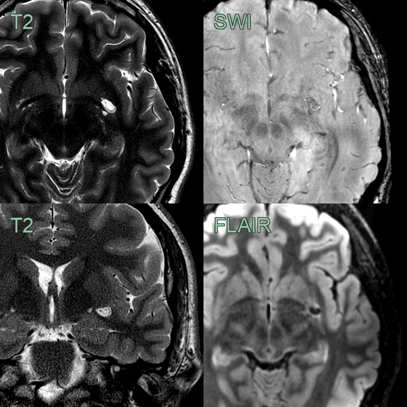 Enlarged perivascular spaces - Neuroradiology