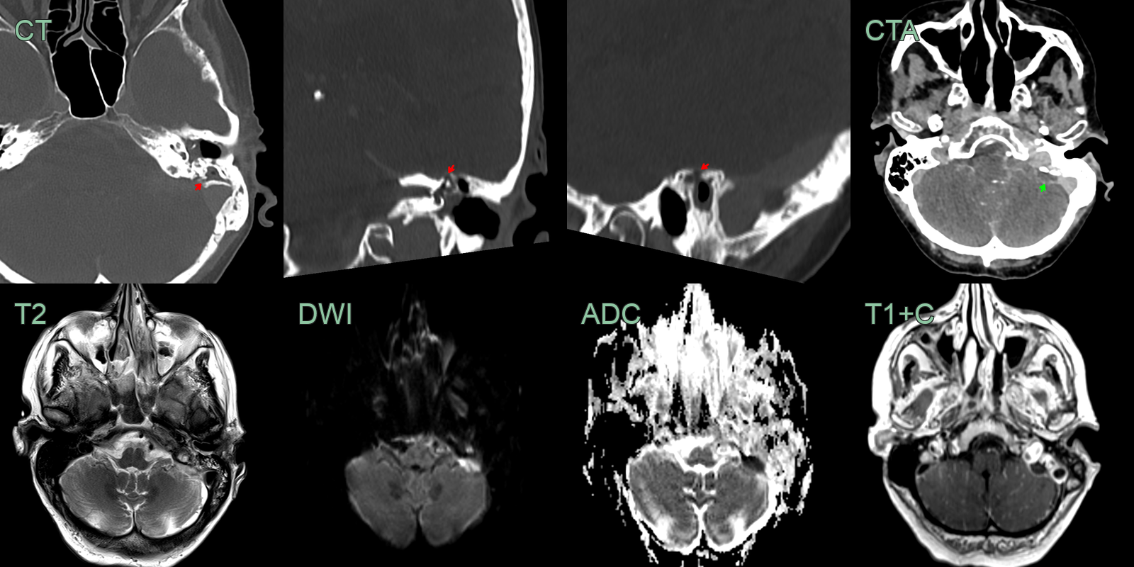 Epidural abscess - Neuroradiology
