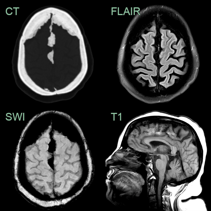 Falx ossification - Neuroradiology