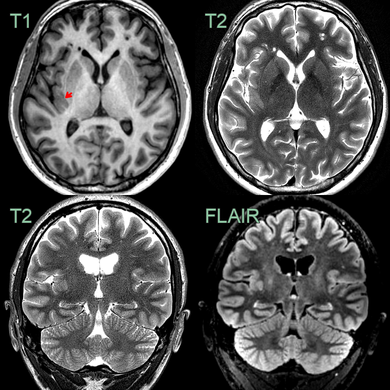 Focal Cortical Dysplasia (FCD) - Neuroradiology