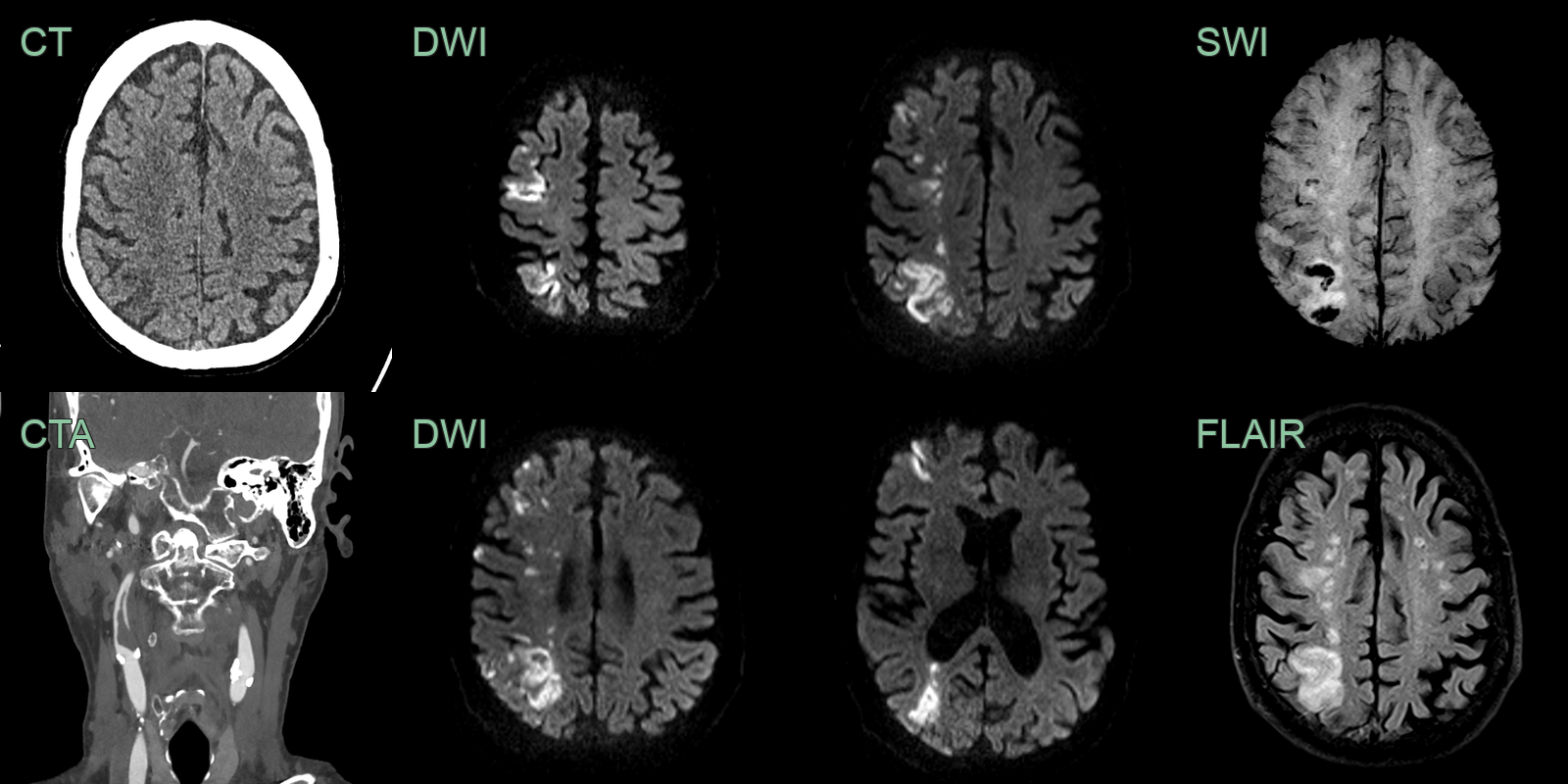 Free floating thrombus - Neuroradiology