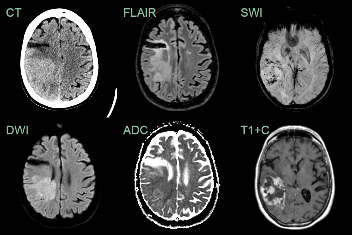 Glioblastoma - Neuroradiology