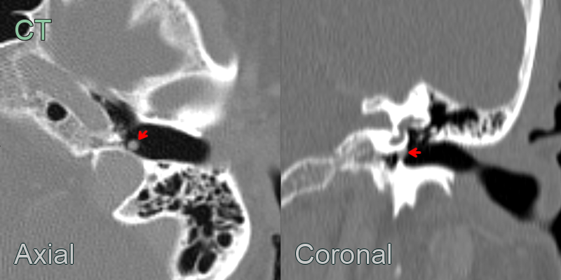 Glomus tympanicum - Neuroradiology
