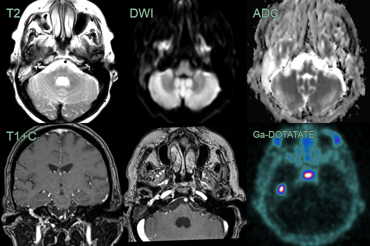 Glomus tympanicum - Neuroradiology