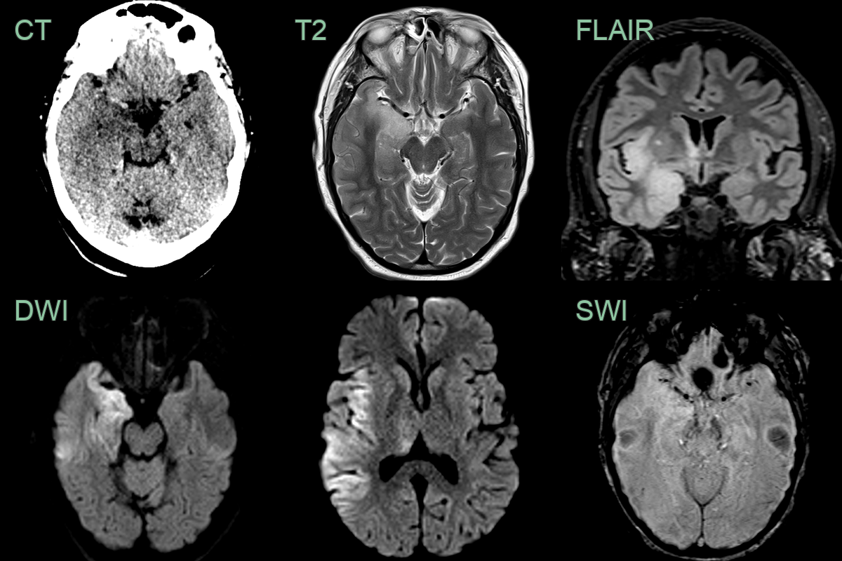 Herpes Simplex Virus (HSV) encephalitis - Neuroradiology