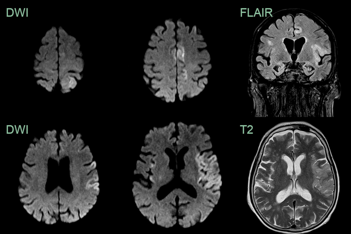 Herpes Simplex Virus (HSV) encephalitis - Neuroradiology