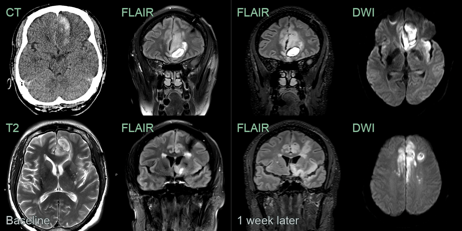 Herpes Simplex Virus (HSV) encephalitis - Neuroradiology