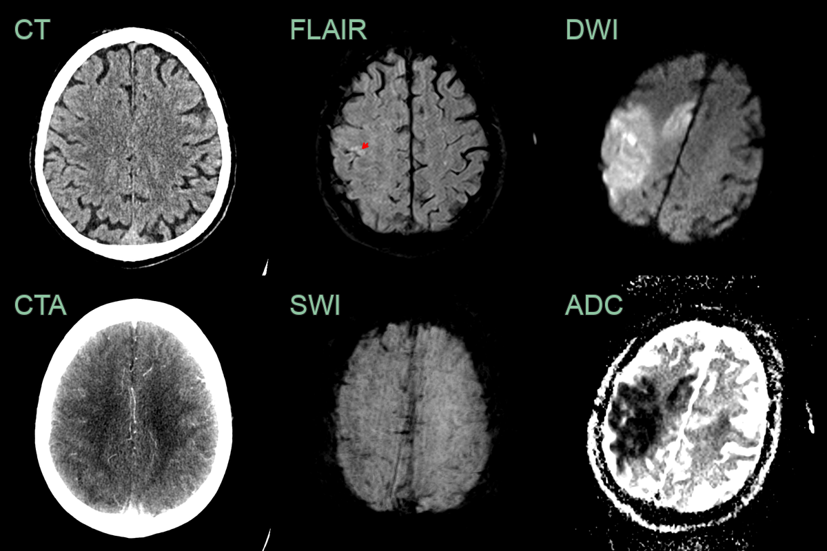 Hyperacute ischemic stroke - Neuroradiology