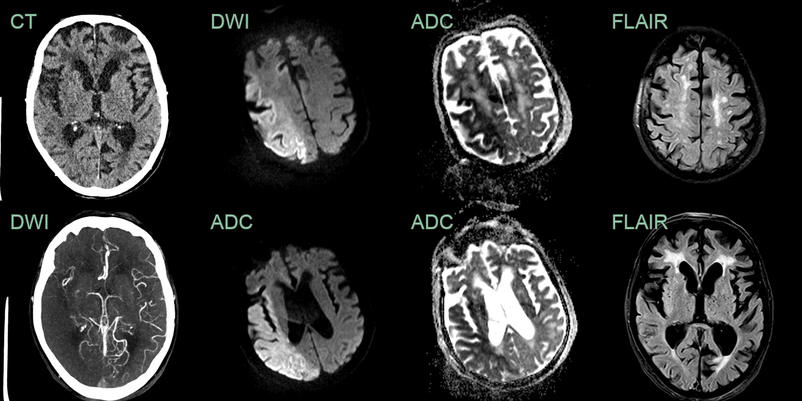 Hyperacute ischemic stroke - Neuroradiology