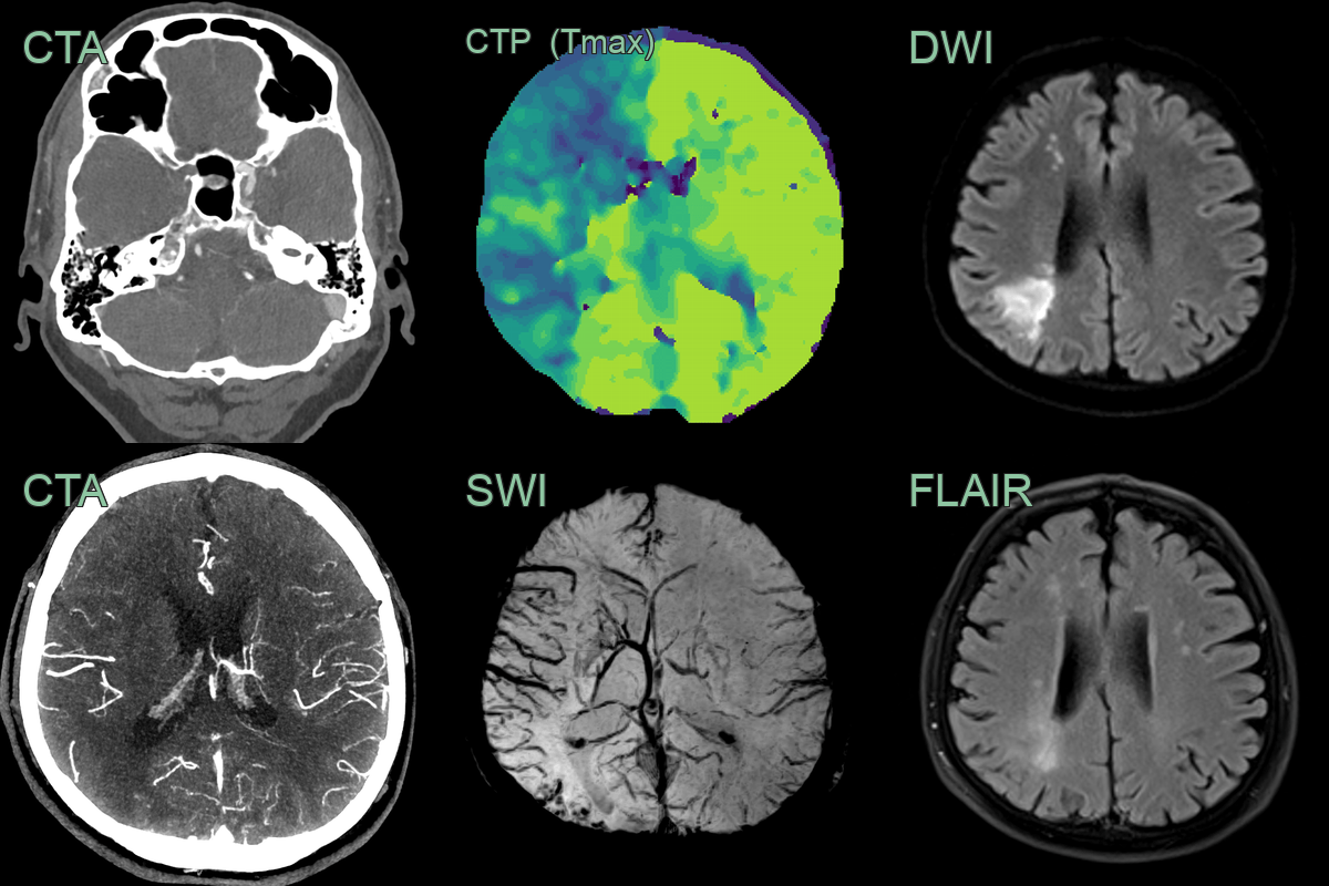 Hyperacute ischemic stroke - Neuroradiology
