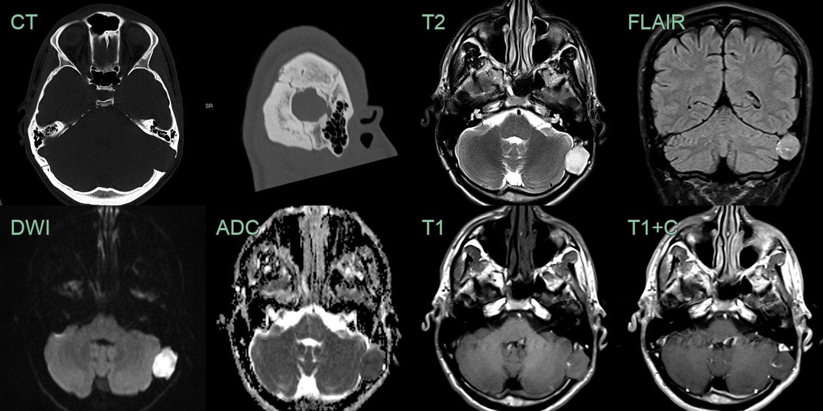 Intradiploic epidermoid - Neuroradiology