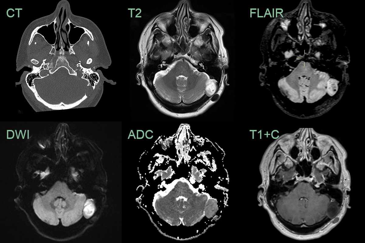Intradiploic epidermoid - Neuroradiology