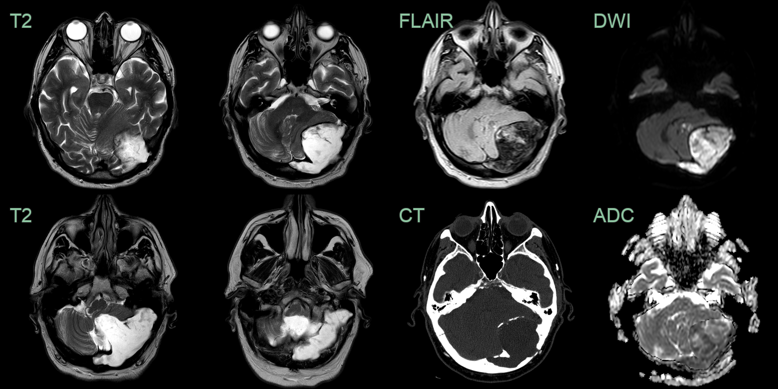 Intradiploic epidermoid - Neuroradiology