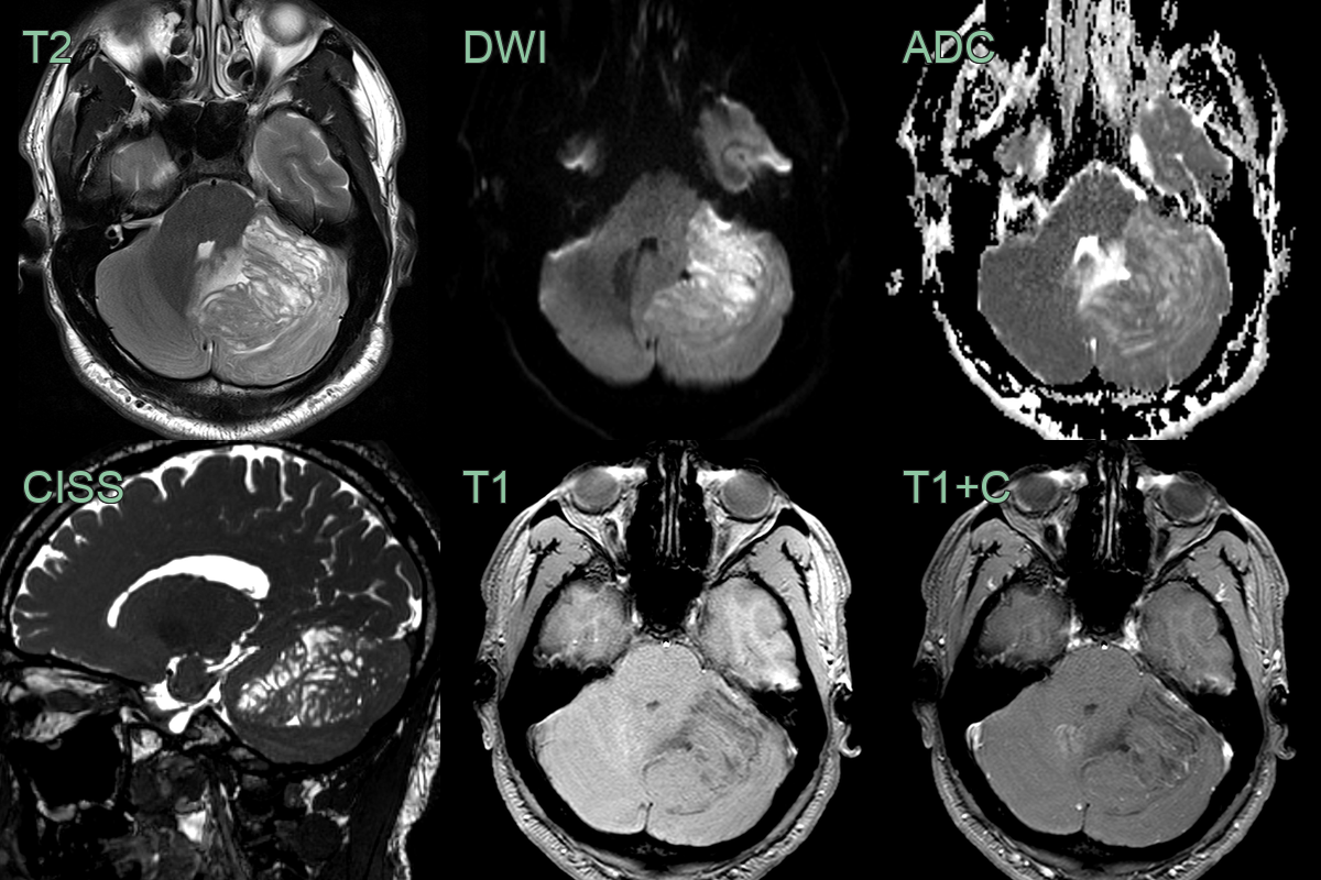 Lhermitte-Duclos Syndrome - Neuroradiology