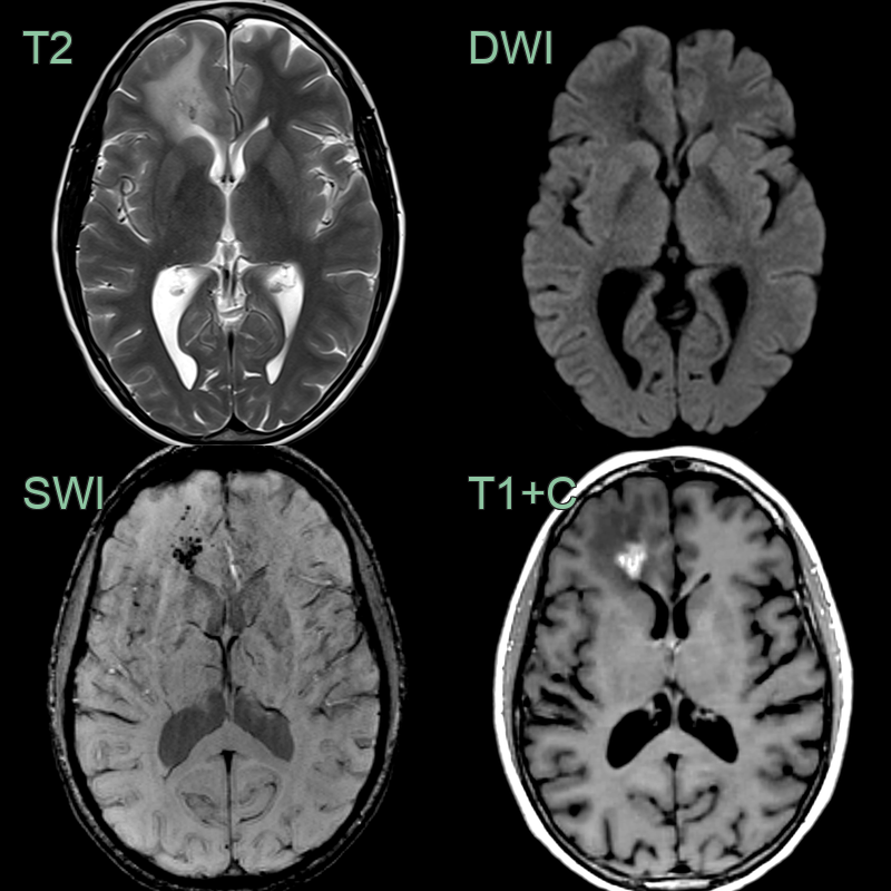 Linear scleroderma - Neuroradiology