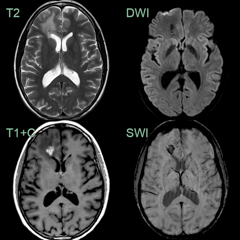 Linear scleroderma - Neuroradiology