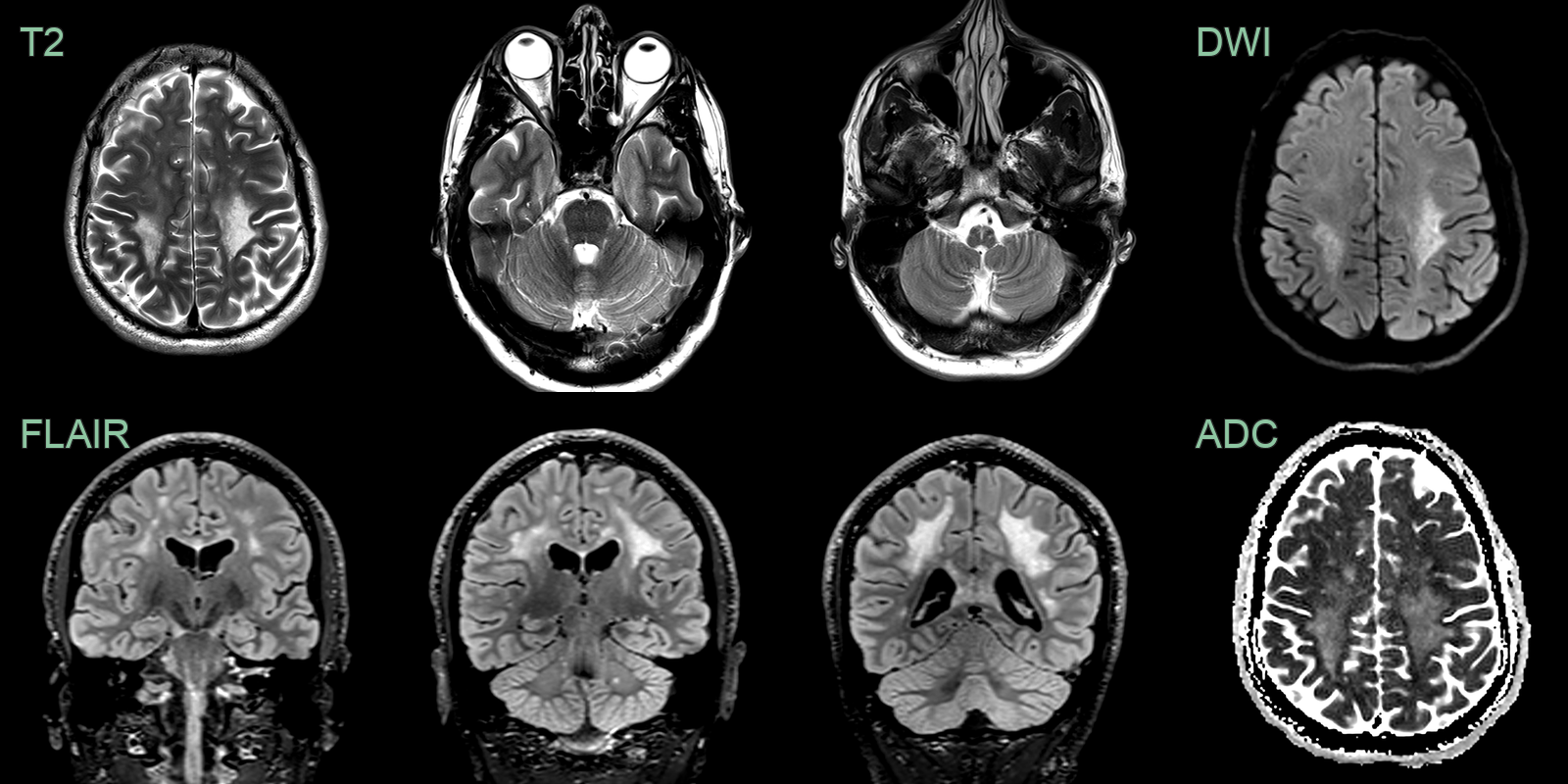 LMNB1-related Autosomal Dominant Leukodystrophy - Neuroradiology