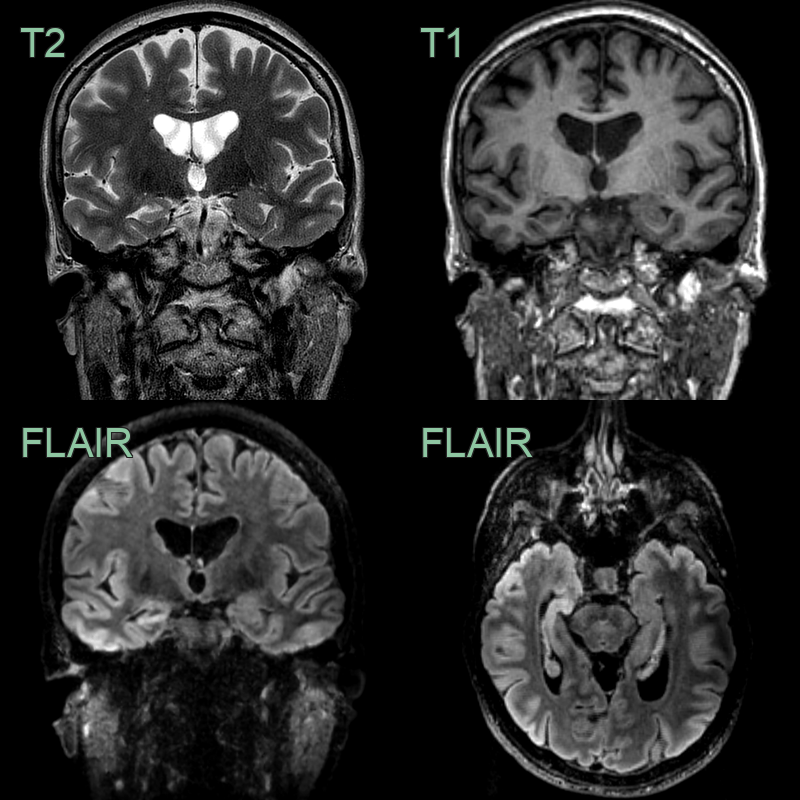 Mesial temporal sclerosis - Neuroradiology