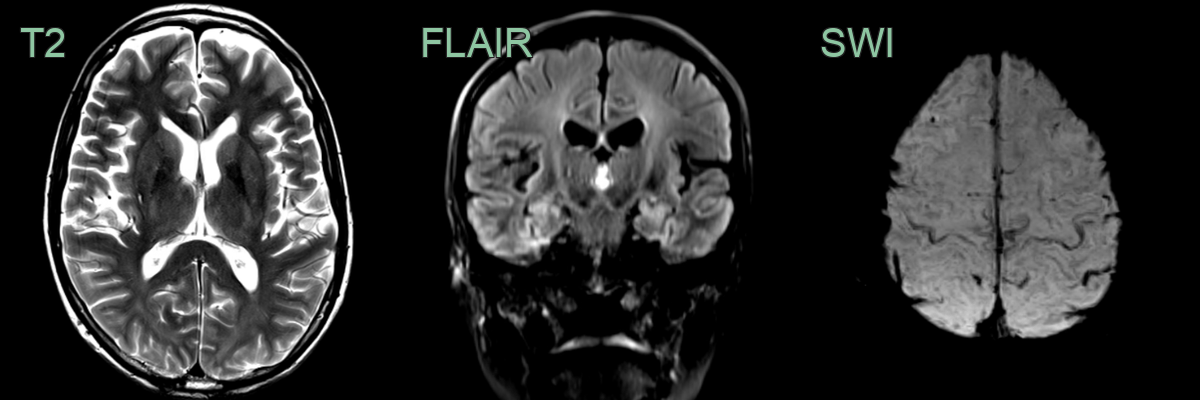 Motor Neurone Disease (MND) - Neuroradiology