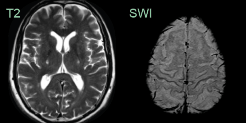Motor Neurone Disease (MND) - Neuroradiology