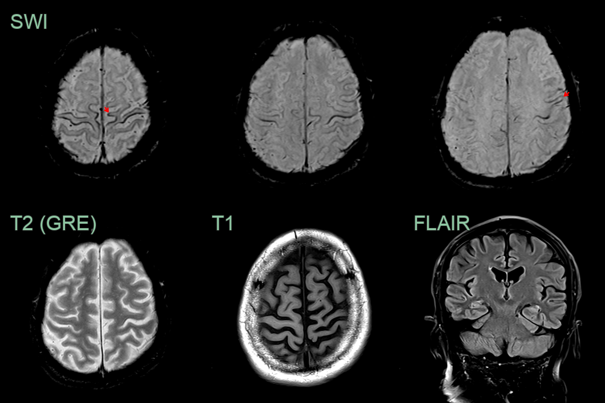 Motor Neurone Disease (MND) - Neuroradiology